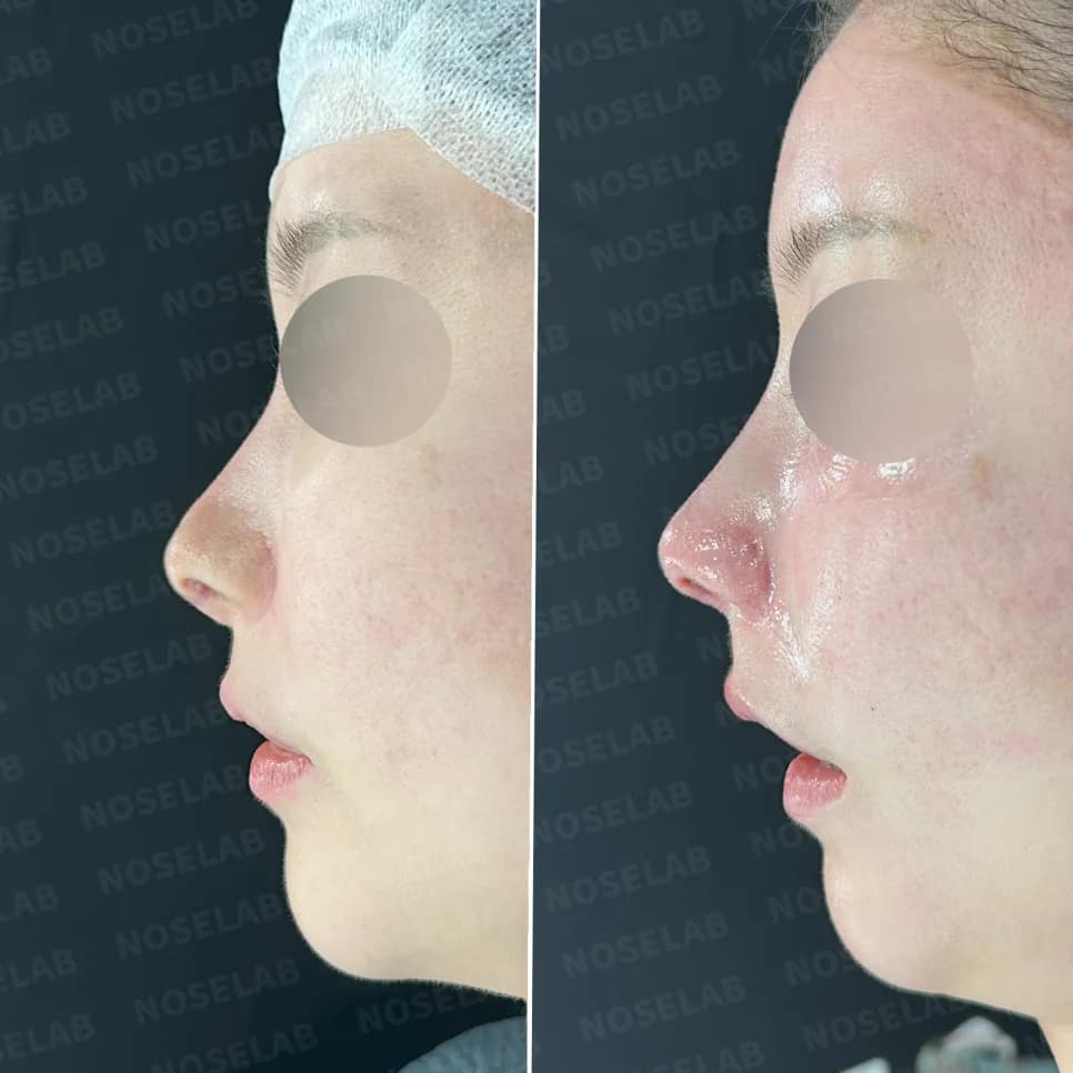 Refinement Surgery for a Higher, More Symmetrical Nose with Closed ...